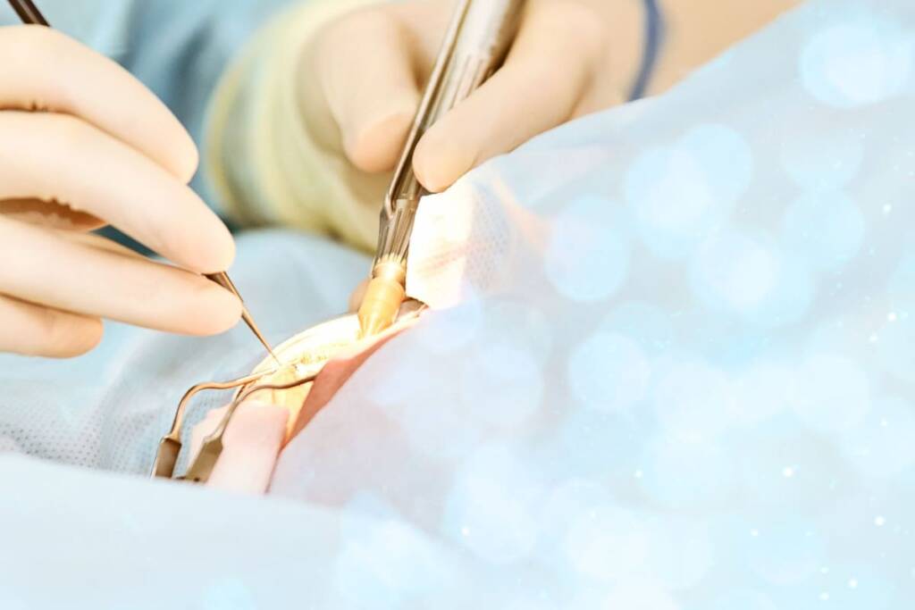 Strabismus Surgery – DR. Ahmed Galal